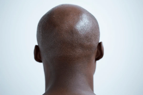 Joy For All Bald people As UGMC Starts Hair-forestation!